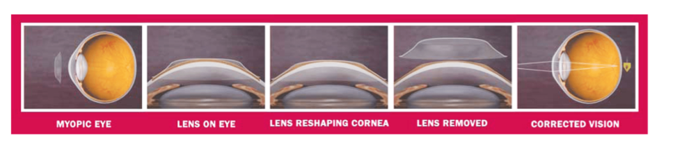 Myopia Management - Busby Eye Care